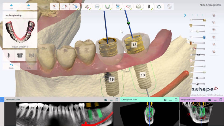 Implant – MODENA DENTAL LAB